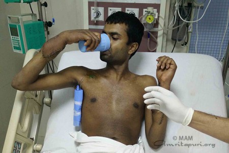 India's first double hand transplant at the Amrita Institute